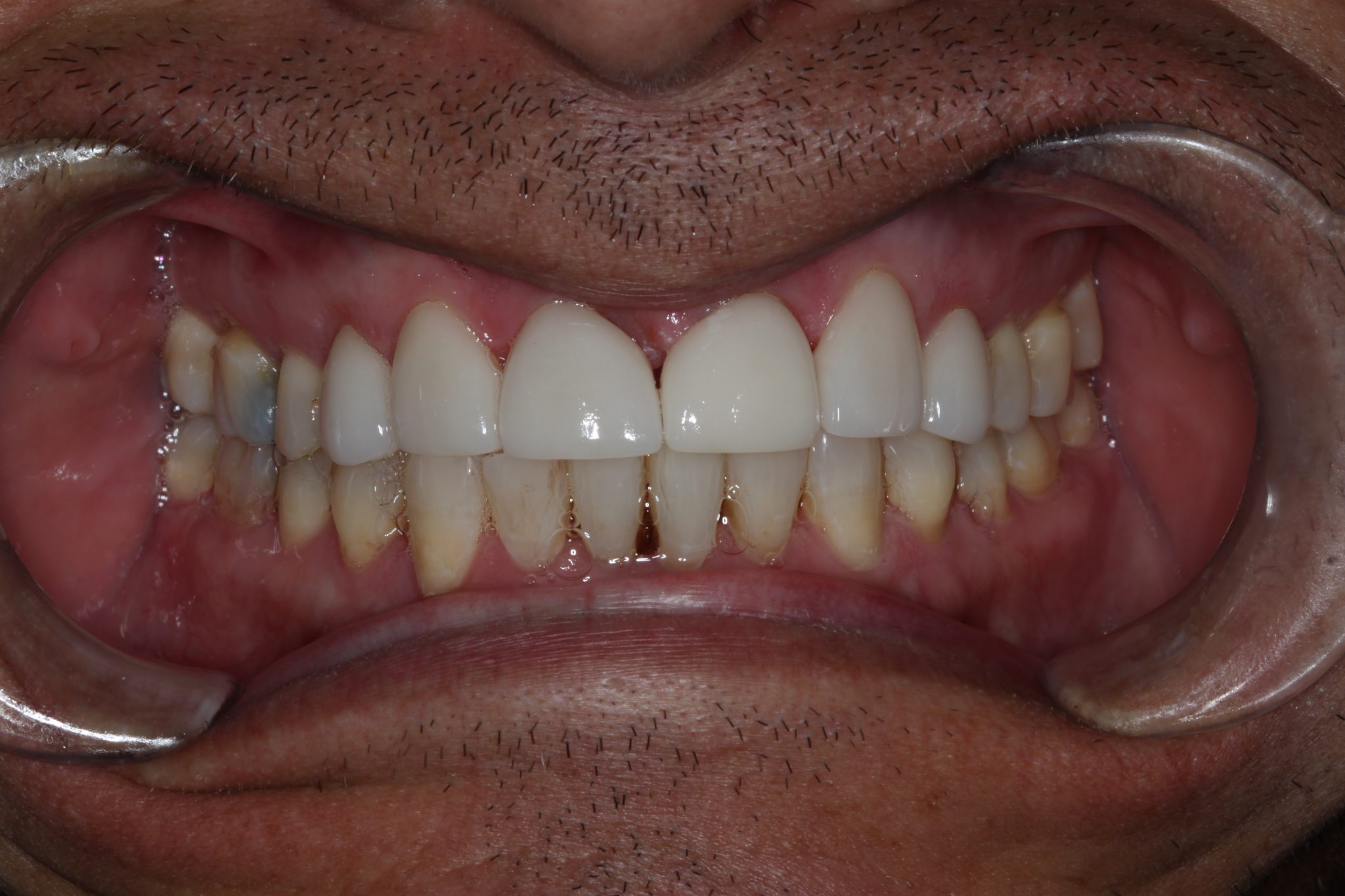 Dentist Spring, TX | SpringLove Dentistry | Smile Gallery